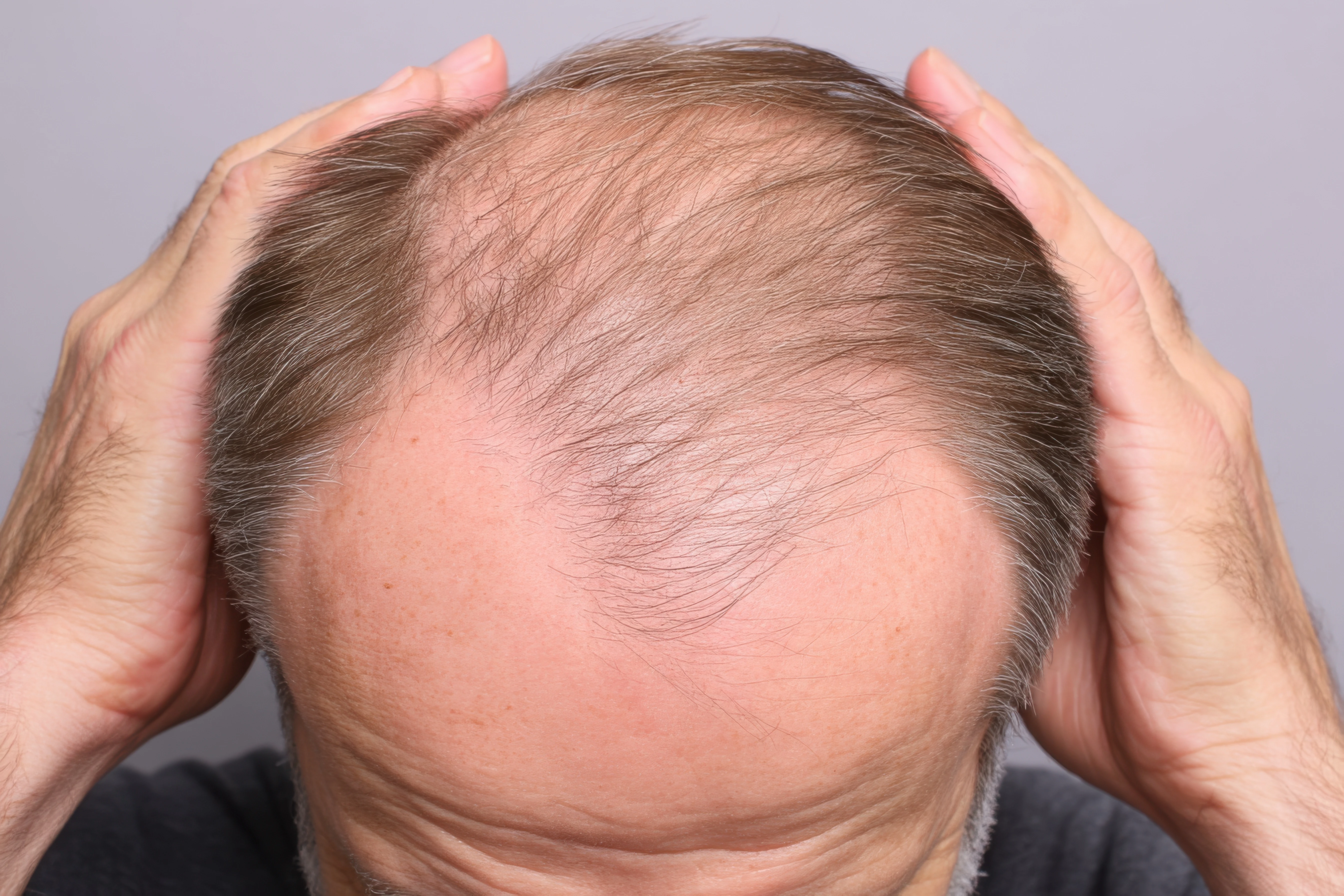 Diffuse Thinning Hair Causes and Treatment Options - Now Hair Time